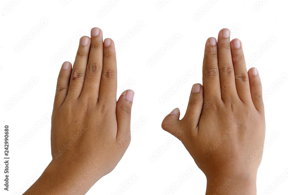 Isolation photo of Polydactyly on human; rare abnormal characteristic ...