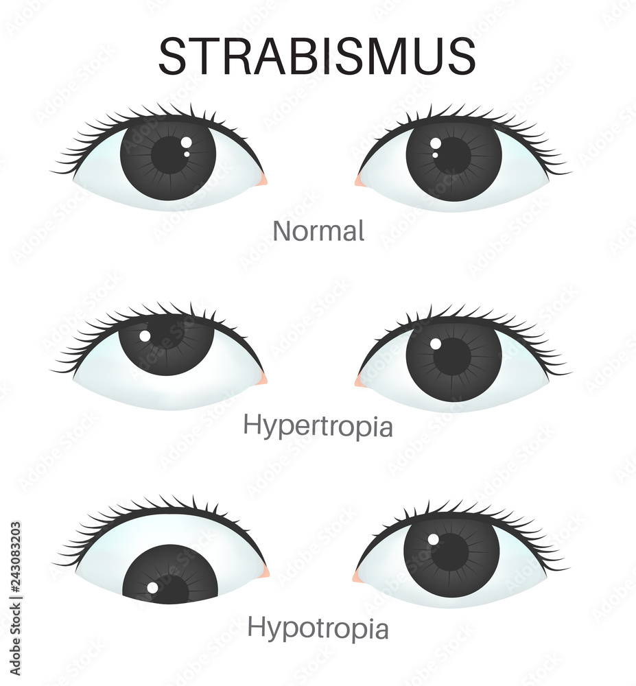 Types of strabismus - Hypertropia and Hypotropia Stock Vector | Adobe Stock
