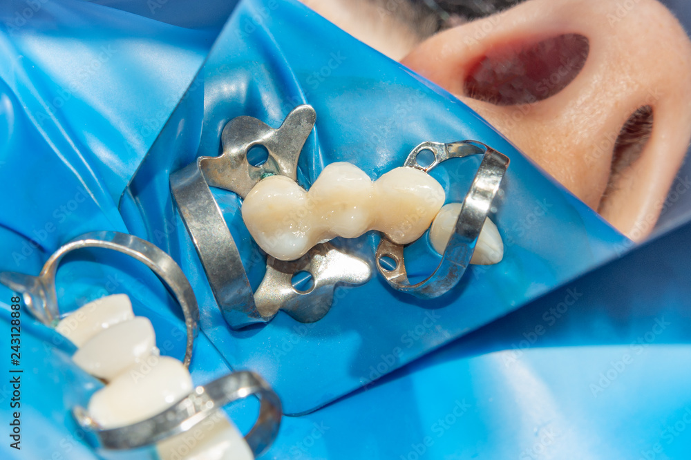 restoration of teeth after endodontic treatment with fiberglass pins ...