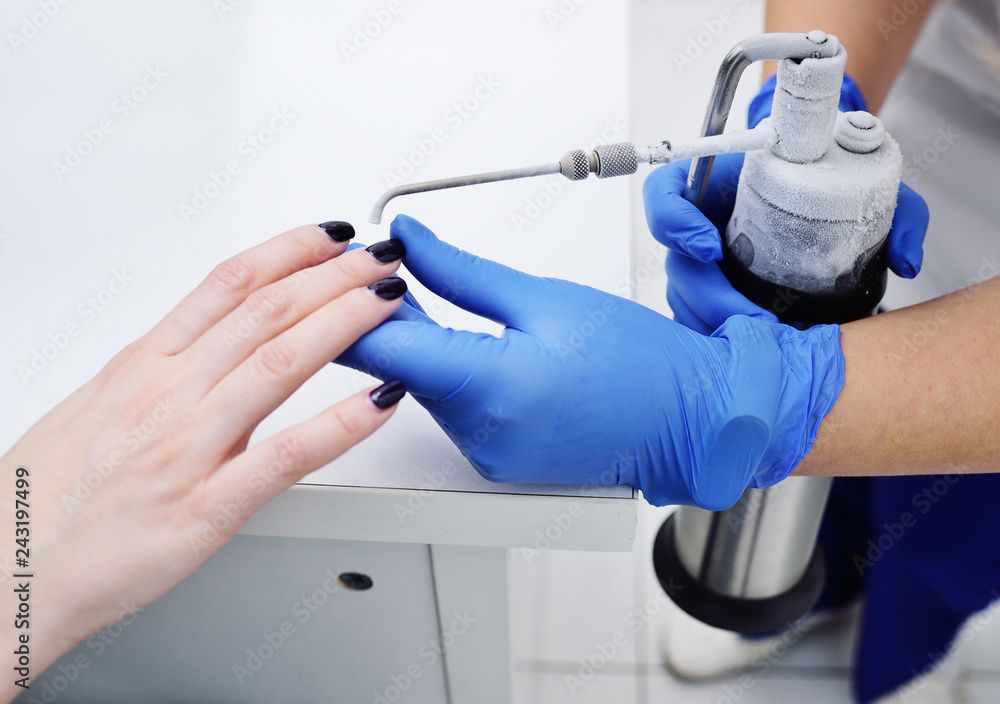 Removal of papillomas and warts on the hand with liquid nitrogen in a ...