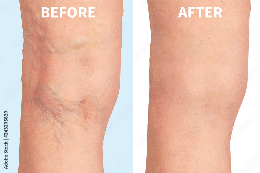 varicose veins on the skin macro close up circulation problem medicine ...