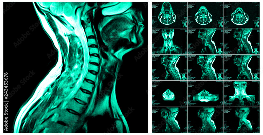 Magnetic resonance imaging of the cervical spine. Stock Photo | Adobe Stock