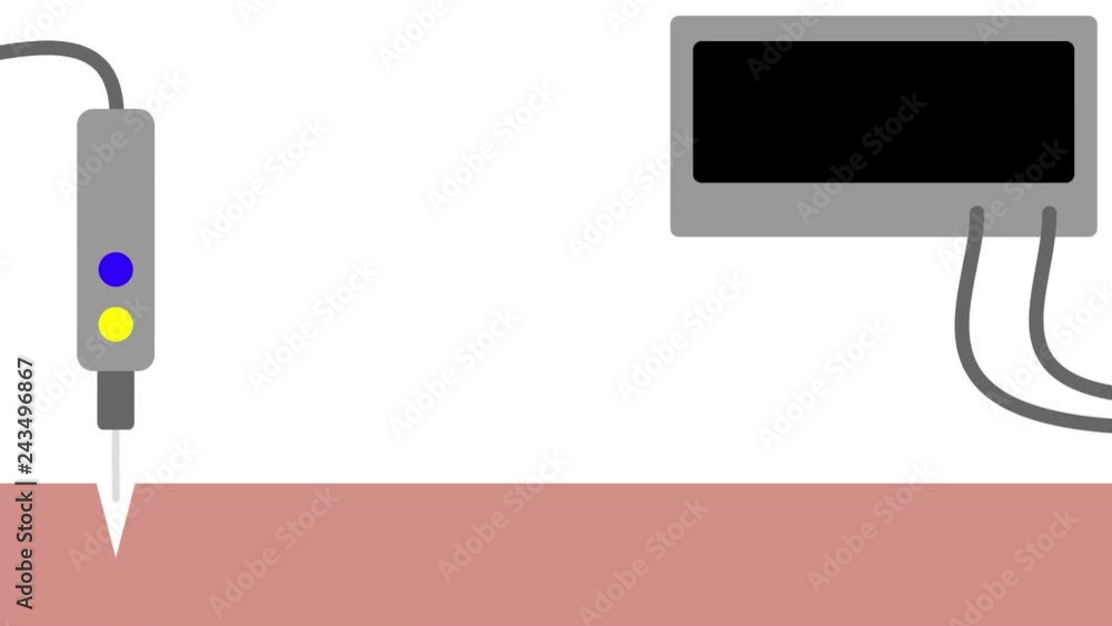 Electrosurgery Monopolar Cutting Animation with American Labeling Stock ...