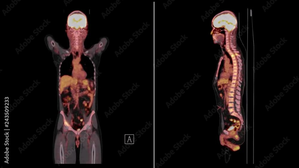 Positron Emission Tomography or PET CT scan of whole human body coronal ...