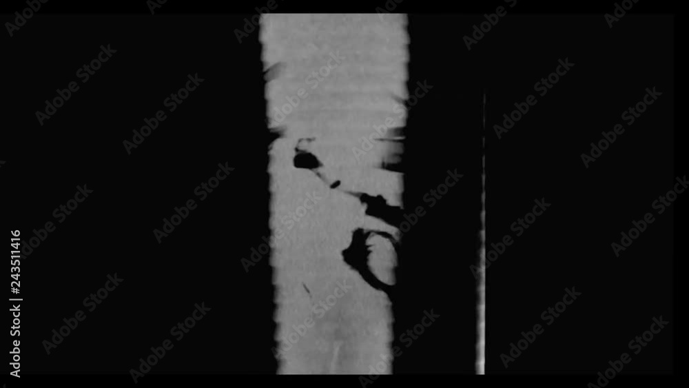 CT angiography or CTA of whole abdomen image coronal view . medical ...