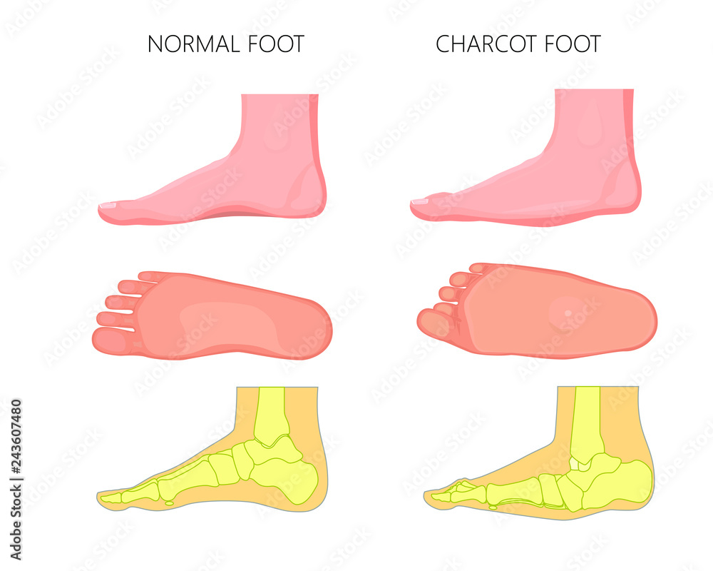 Stockvektorbilden Illustration Of Normal And Rocker Bottom Charcot Foot