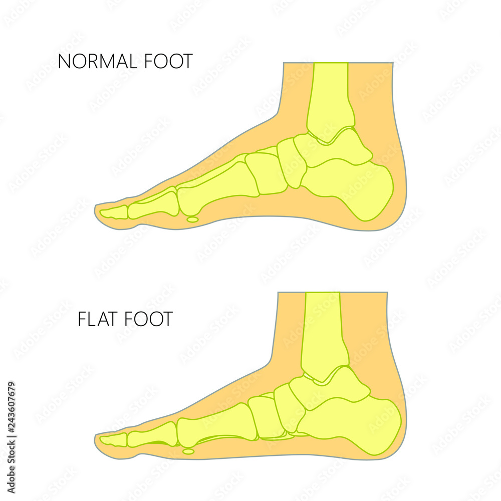 Skeletal illustration of a normal foot and a flat foot. Stock Vector ...