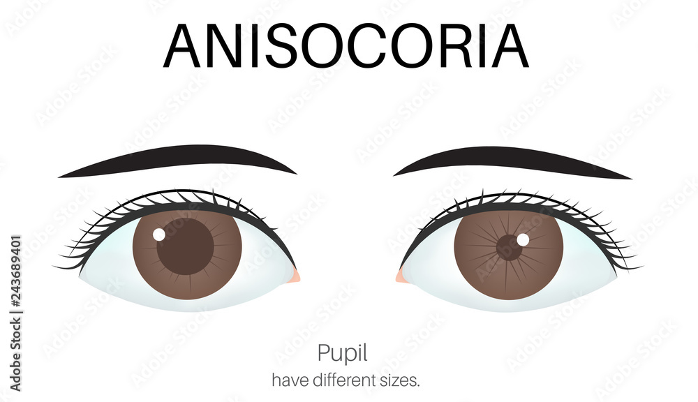 Image of eye with anisocoria Stock Vector | Adobe Stock