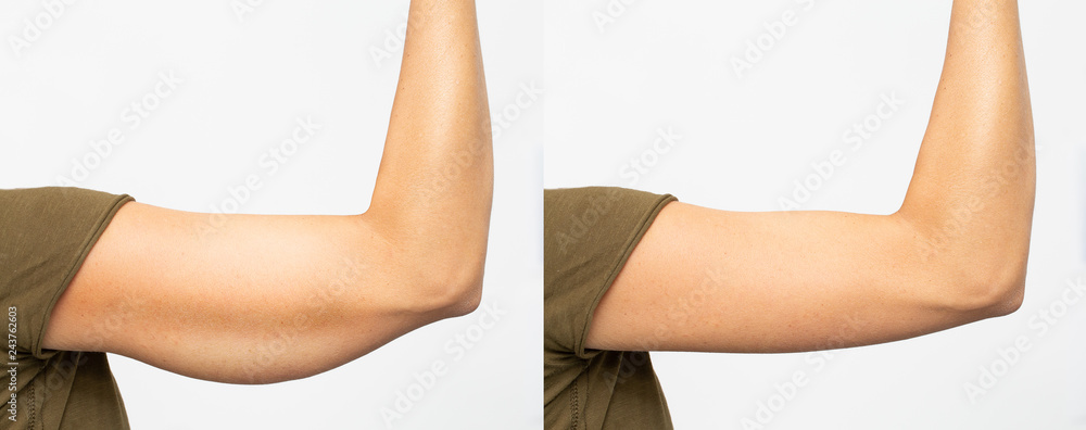 Before and after excess skin removal under the arm Stock Photo | Adobe ...