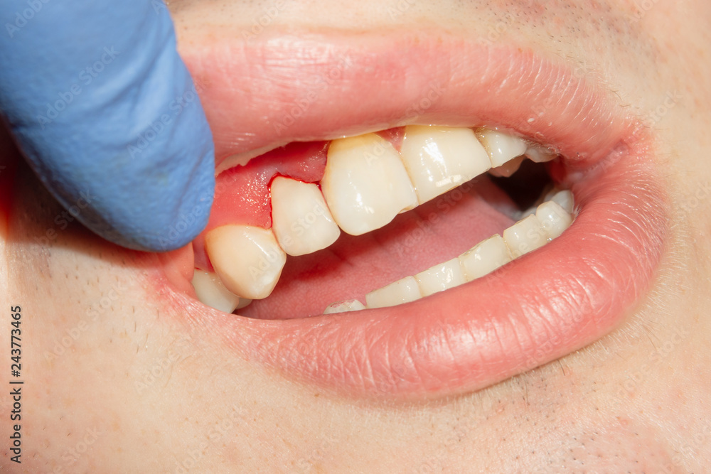 two chewing side teeth of the upper jaw after treatment of caries ...