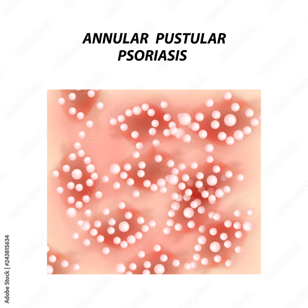 Annular pustular psoriasis. Eczema, dermatitis skin disease psoriasis ...