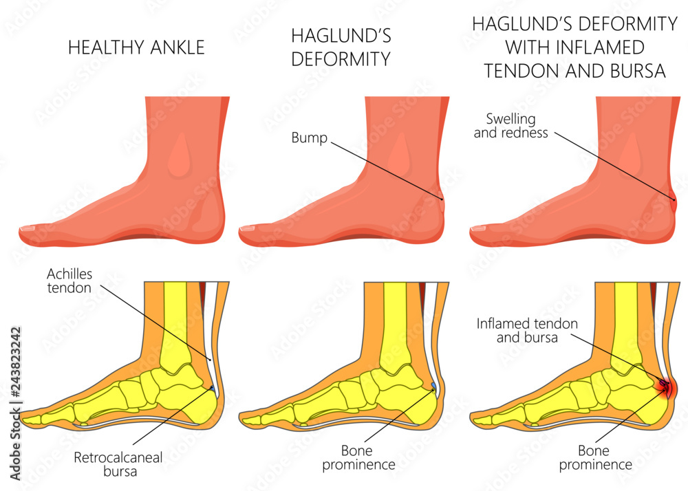 Illustration of an ankle (side view) with Haglund's deformity, inflamed ...