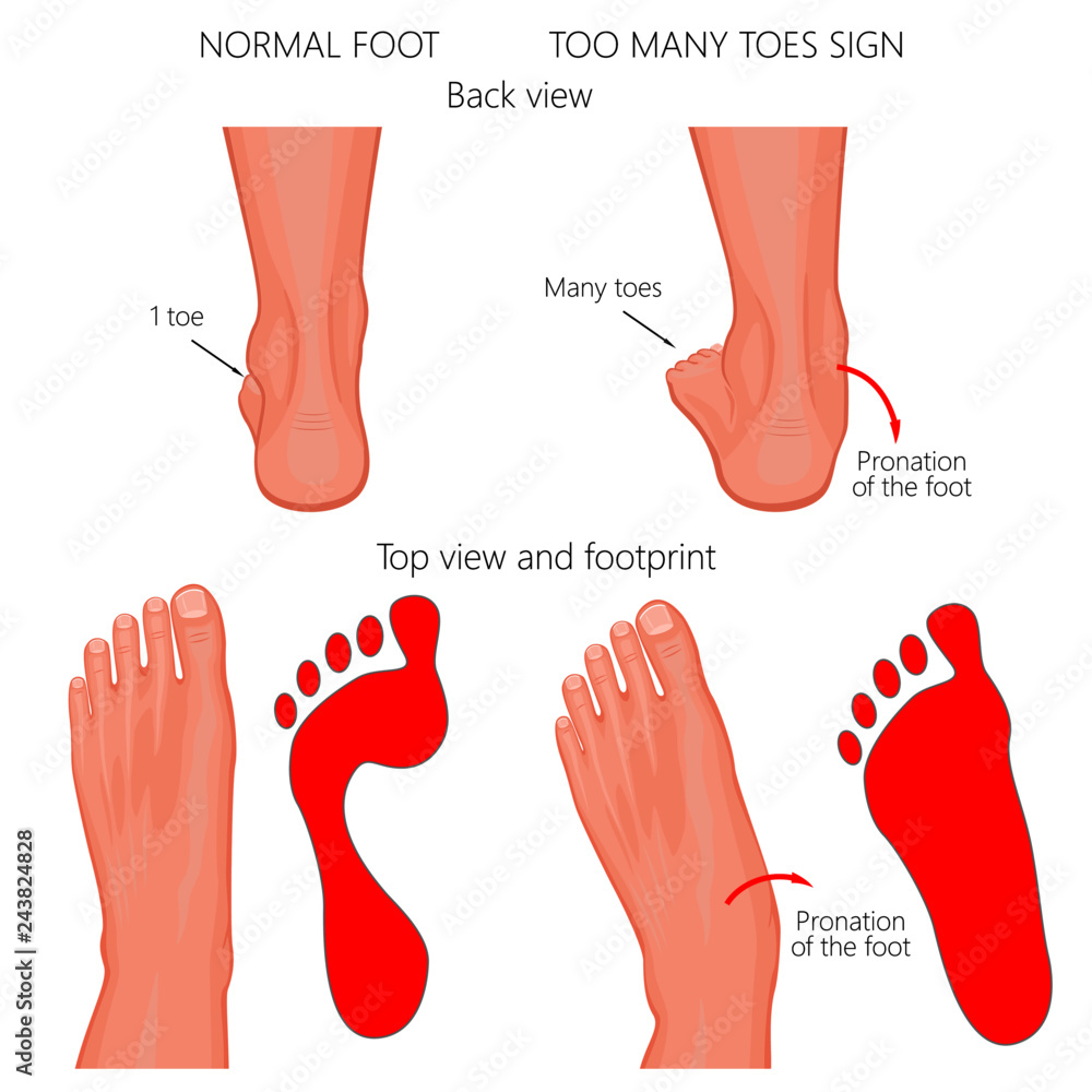 Vector illustration of the normal human foot and the foot with ...