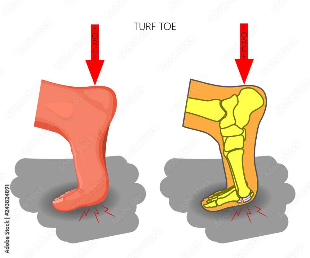 Vector illustration (diagram).Turf toe. Sport trauma. Mechanism of ...
