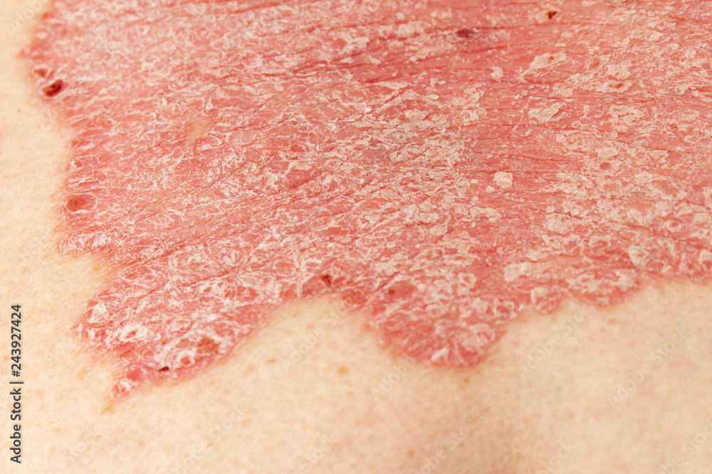 Detail of psoriatic skin disease Psoriasis Vulgaris with narrow focus ...