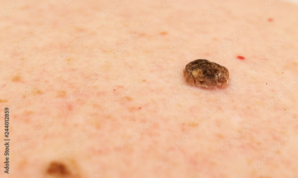 Seborrheic keratosis also known as seborrheic verruca or a senile wart ...