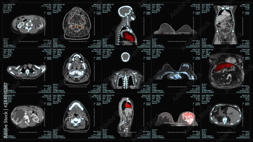 MRI Scan screen with additional medical data. CT or CAT scan pictures ...
