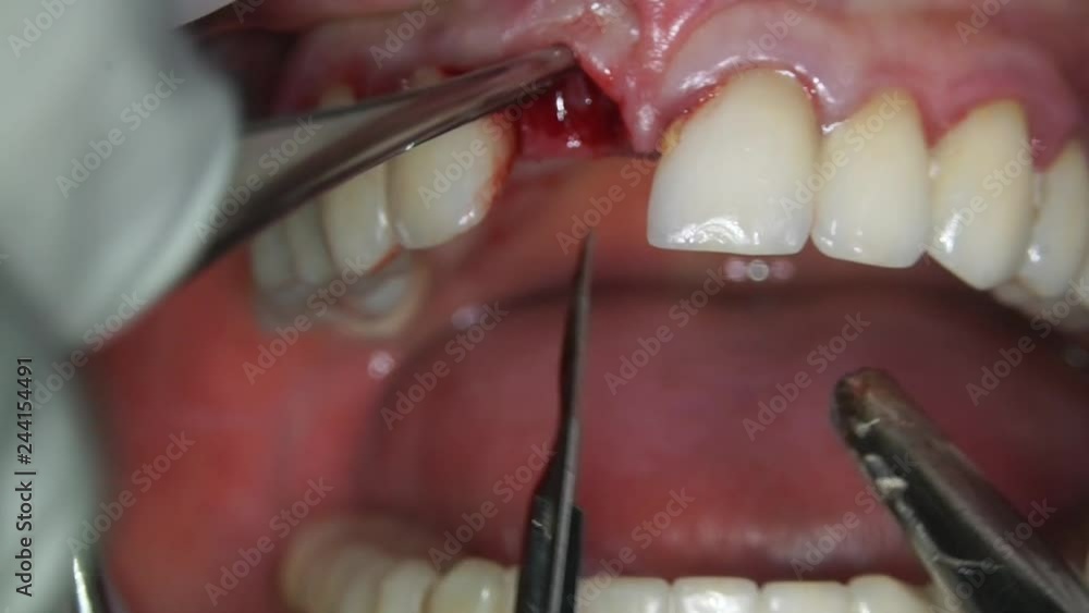preparation of the gums for implantation and removal of small soft ...