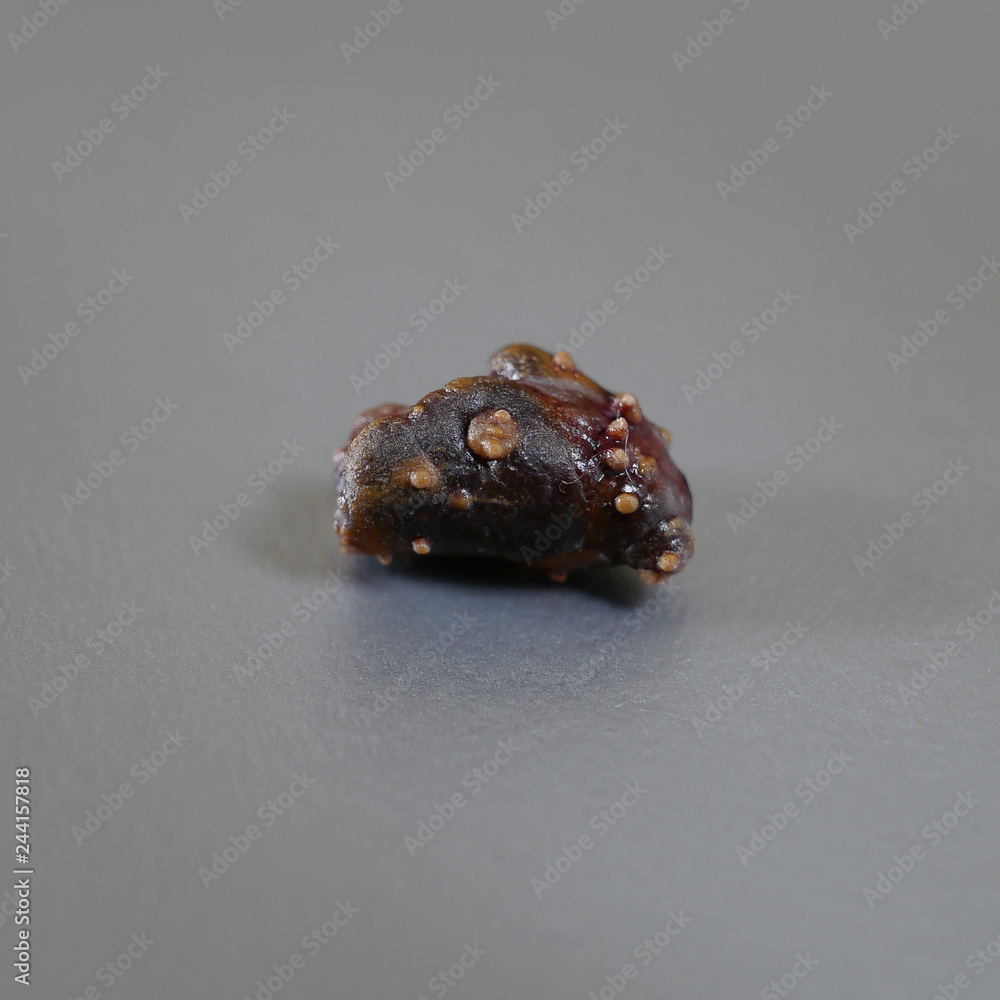 Calcium Oxalate Monohydrate Stones