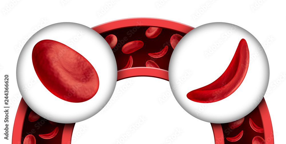 Sickle Cell Disease Stock Illustration | Adobe Stock