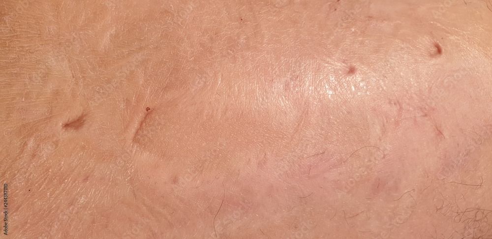 Burns on the human body.Scar from burns on the body. Wounds on the body ...