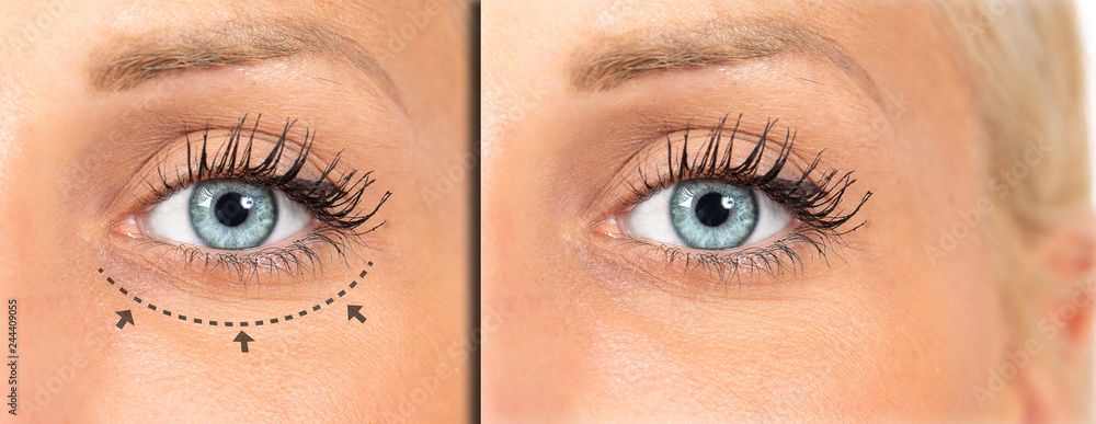 Surgical plasty lines of a blepharoplasty, eyes before and after ...