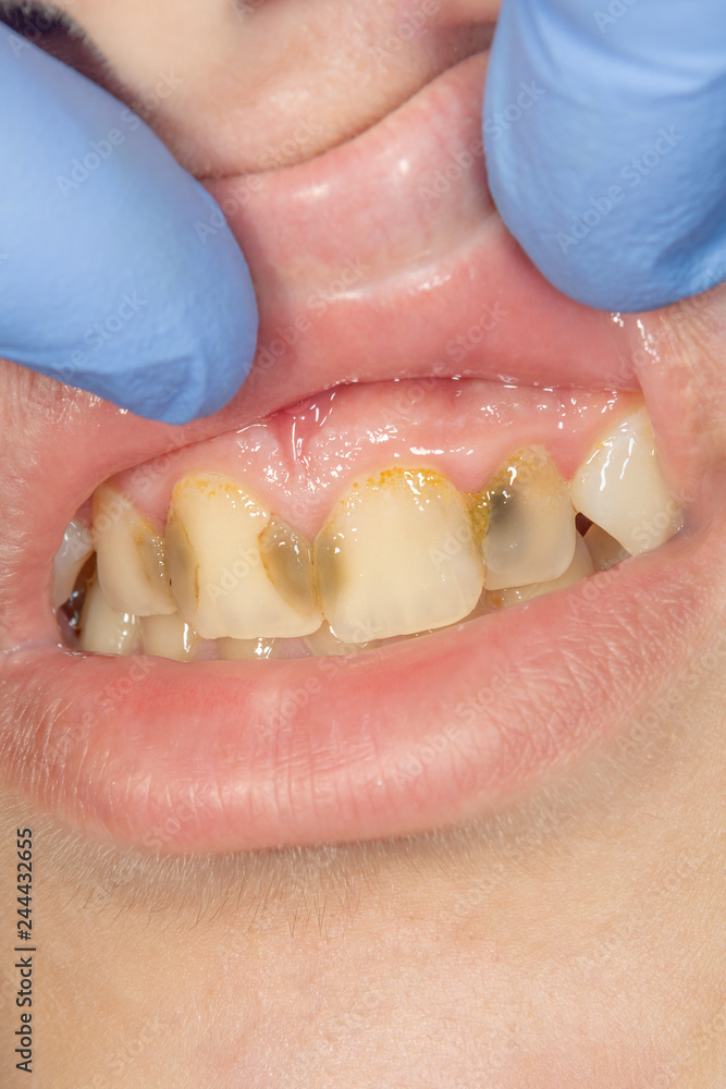 closeup treated human tooth in a dental filling rotten clinic Stock ...