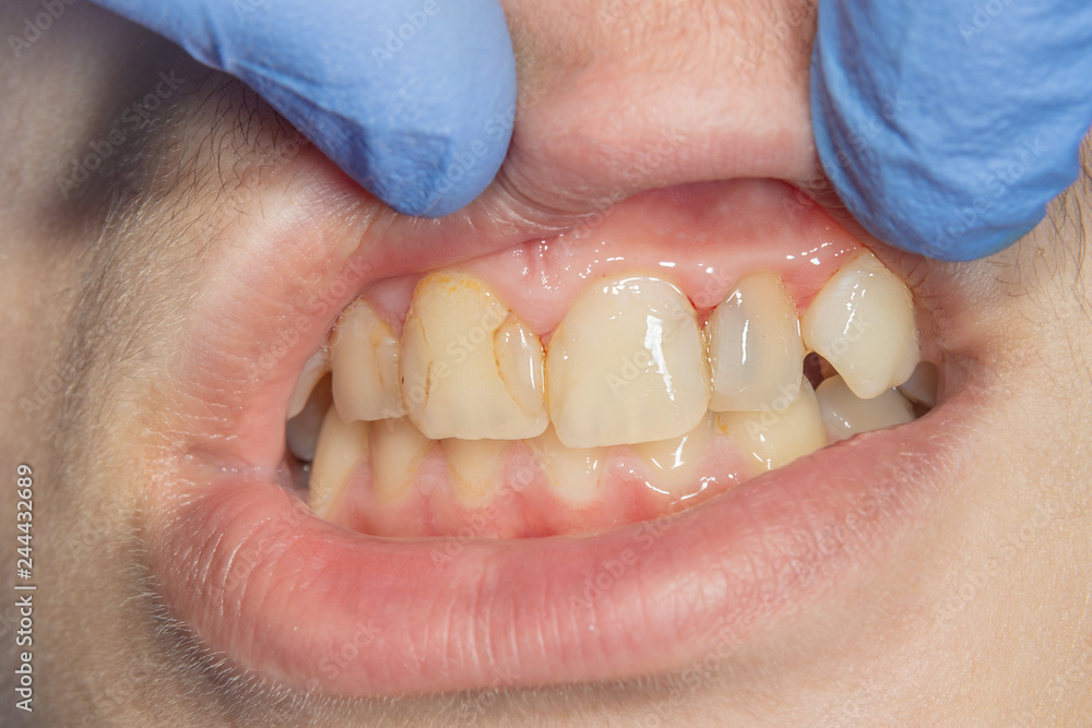 two chewing side teeth of the upper jaw after treatment of caries ...