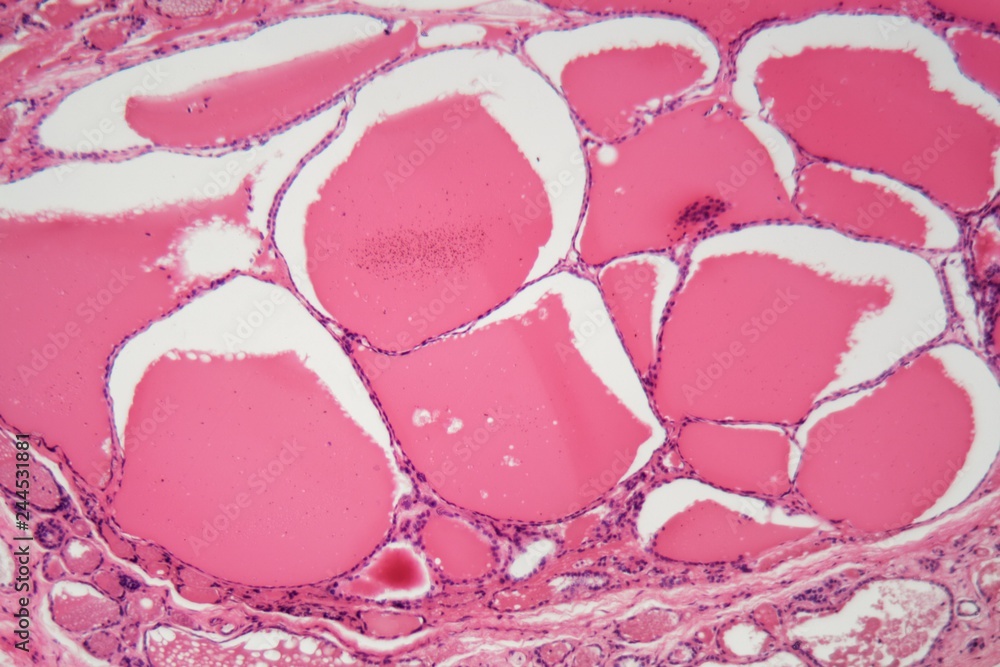 Cells of a human thyroid gland with swelling under a microscope. Stock ...