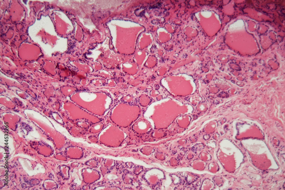 Cells of a human thyroid gland with swelling under a microscope. Stock ...