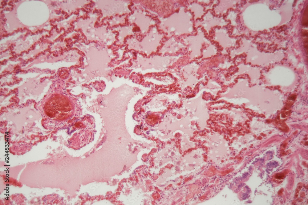 Lung tissue with pneumonia infection caused by flu (Viral pneumonia ...