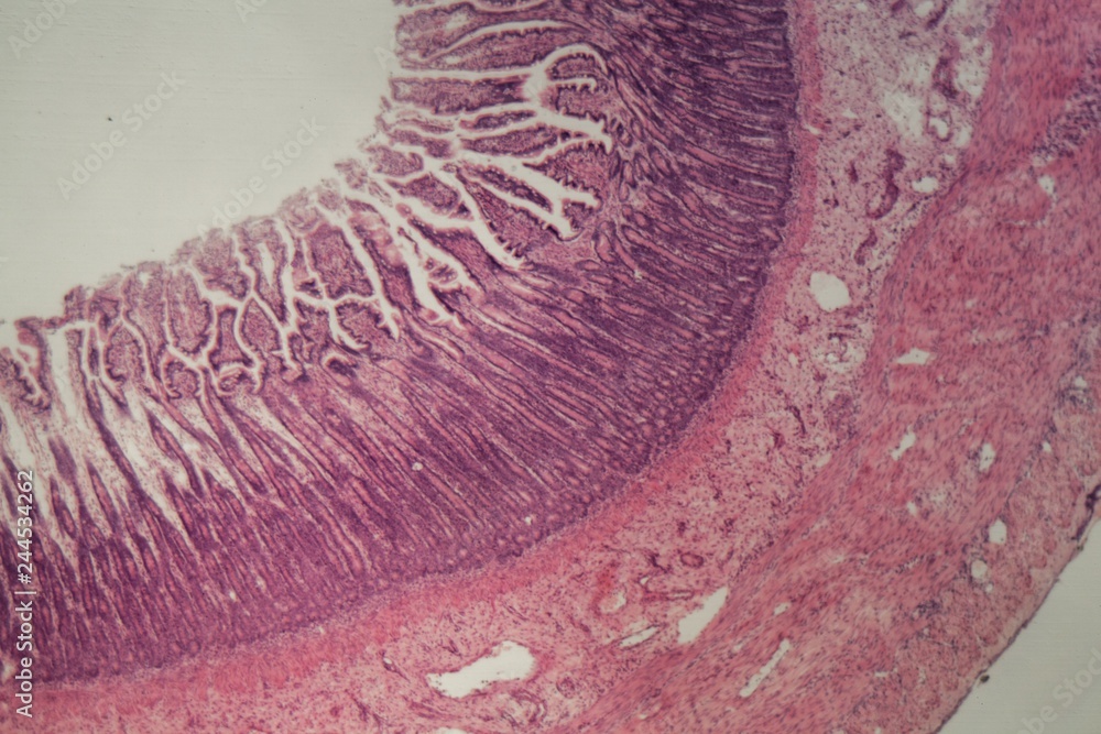 Microscope photo of a large intestine section with inflammation ...