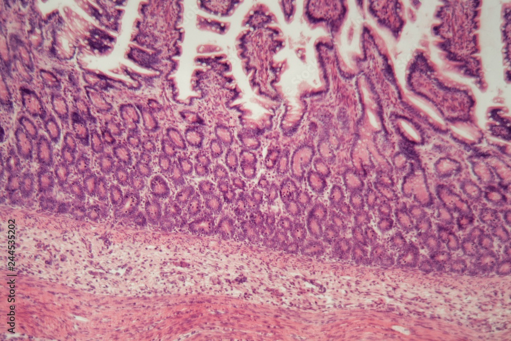 Microscope photo of a large intestine section with inflammation ...