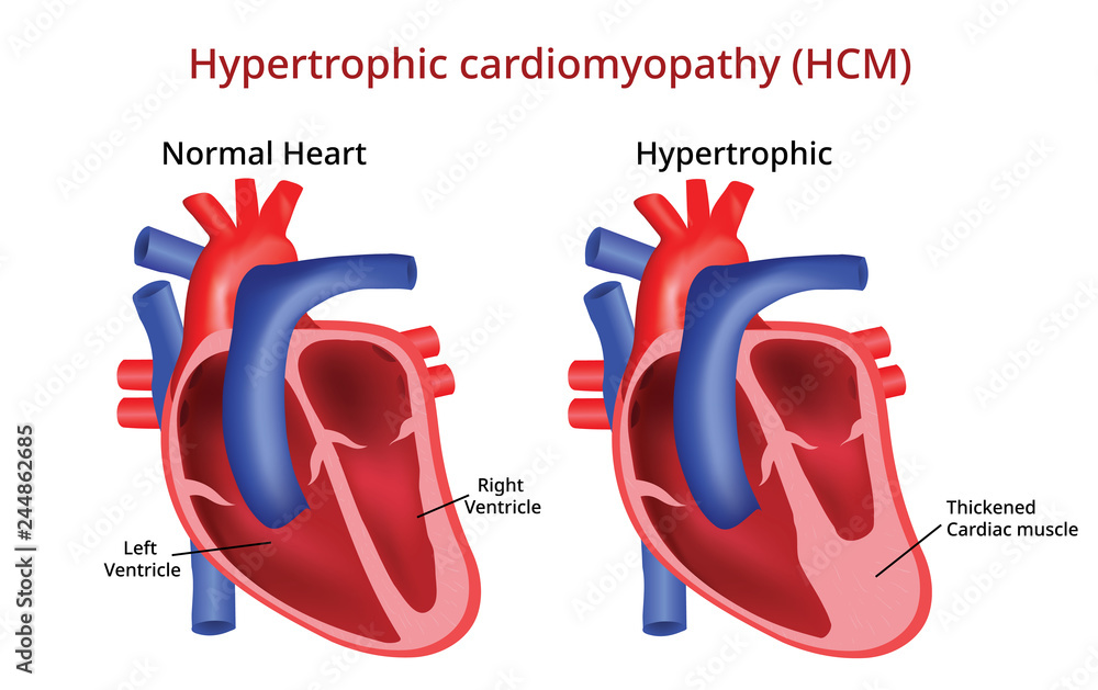 Hypertrophic cardiomyopathy, Heart disease Stock Vector | Adobe Stock