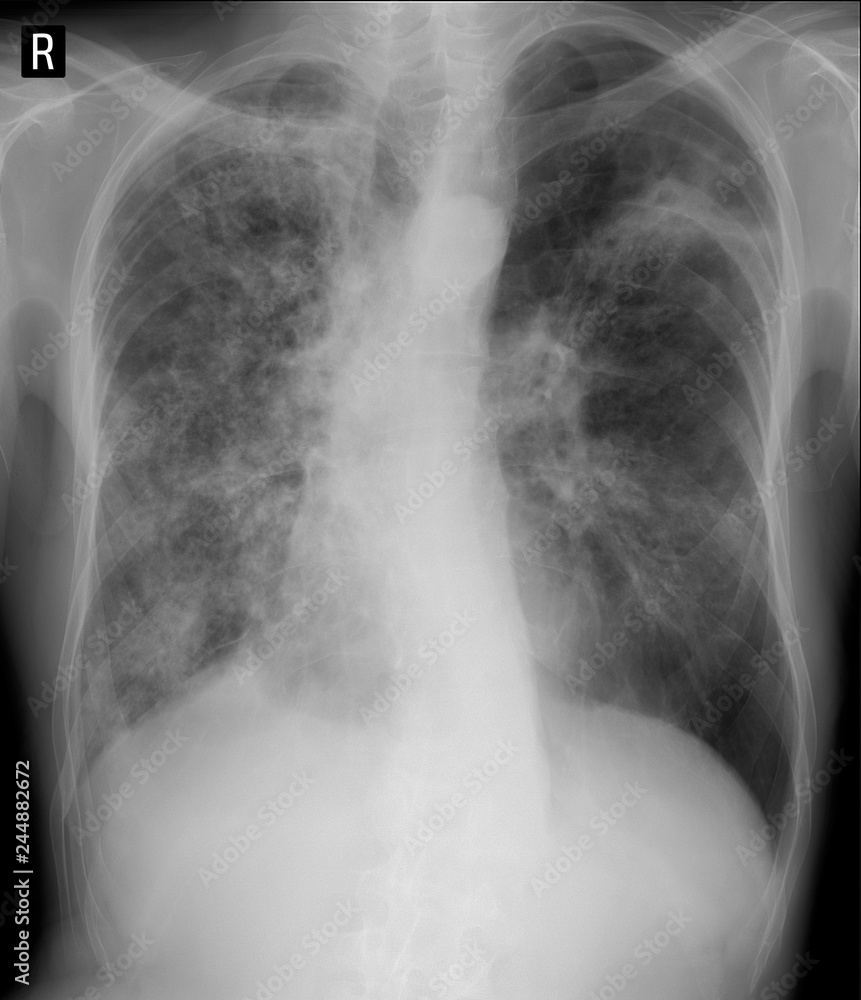 X-ray of the lungs. Fibrous-cavernous tuberculosis. Stock Photo | Adobe ...