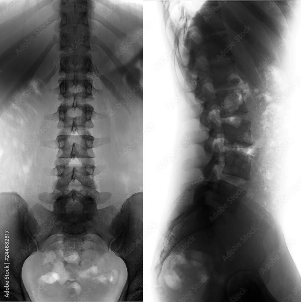 X-ray of the lumbosacral spine. Normal. Negative. Perfect. Stock Photo ...