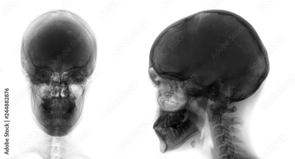 X-ray of the skull. Osteoid-osteoma of the frontal sinus. Negative ...