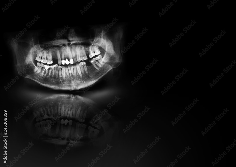 Panoramic radiograph is a scanning dental X-ray of the upper jaw ...