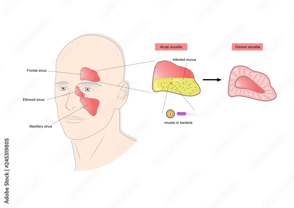 acute and chronic sinusitis Stock Illustration | Adobe Stock