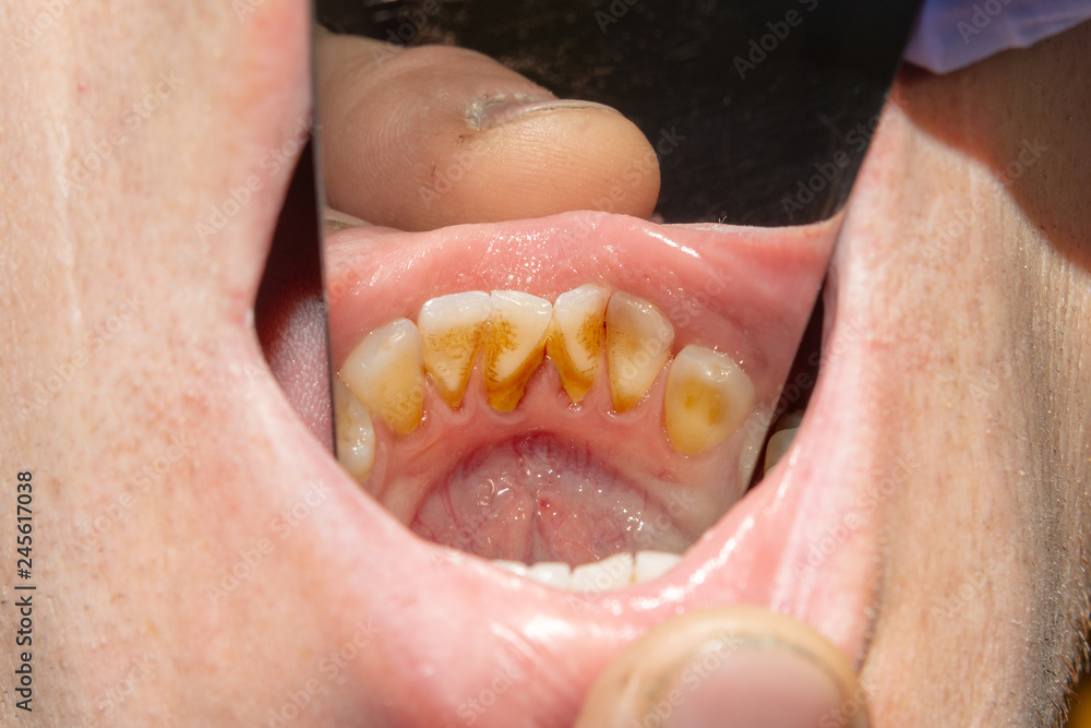 rotten teeth, caries and plaque close-up an asocially ill patient. The ...