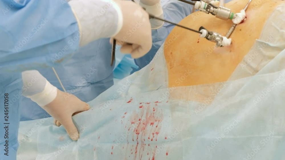 Endoscopy Laparoscopy The Hands Of Doctors Using Laparoscopic 7730