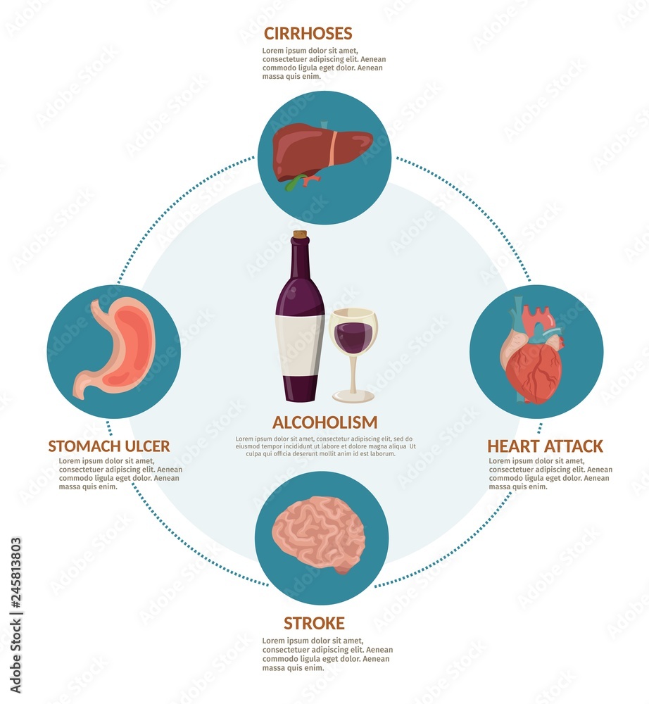 Diseases from alcoholism. Medical infographics. Vector illustration ...