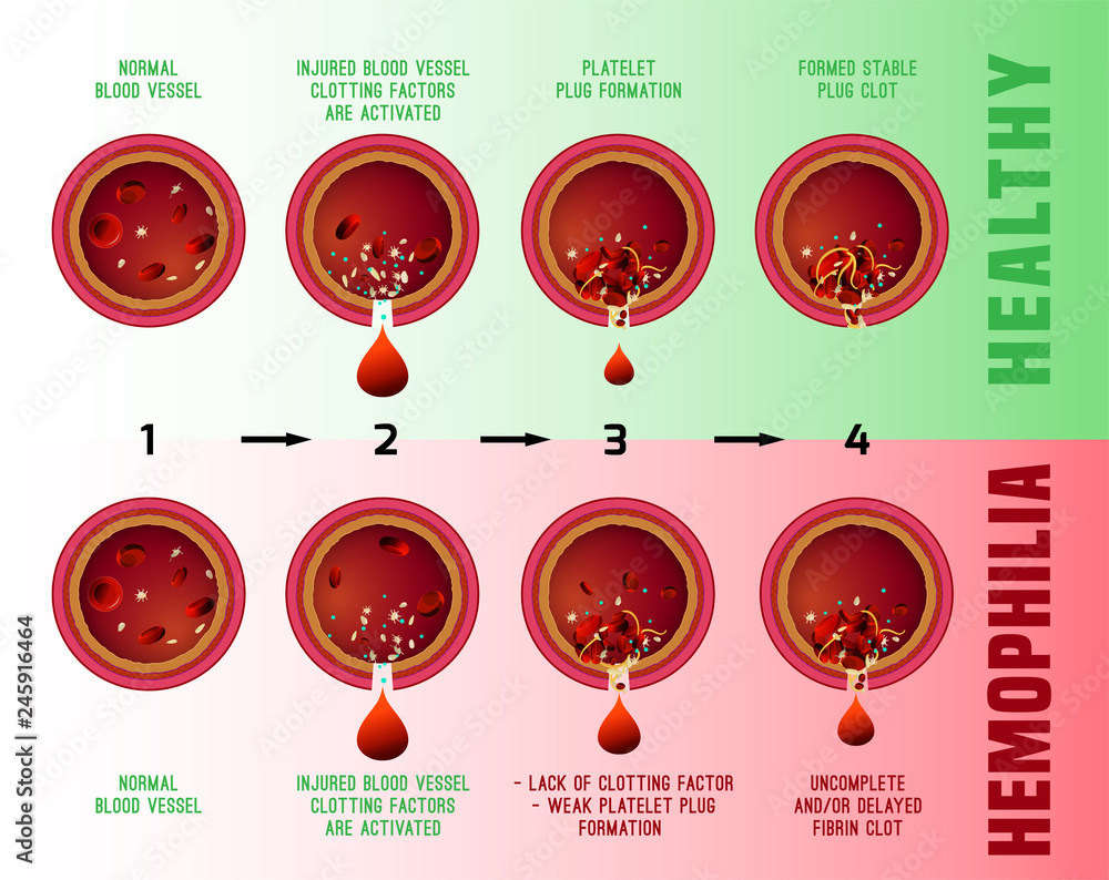 Blood Clotting Scheme Stock Vector | Adobe Stock