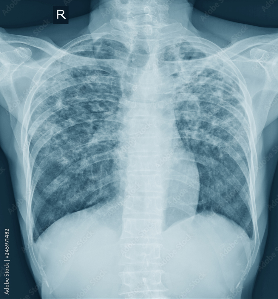 Pulmonary Tuberculosis ( TB ) : Chest x-ray . Stock Photo | Adobe Stock