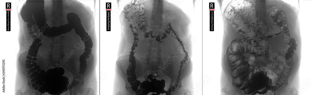 X-ray of the lower parts of the gastrointestinal tract (GI). Tight ...