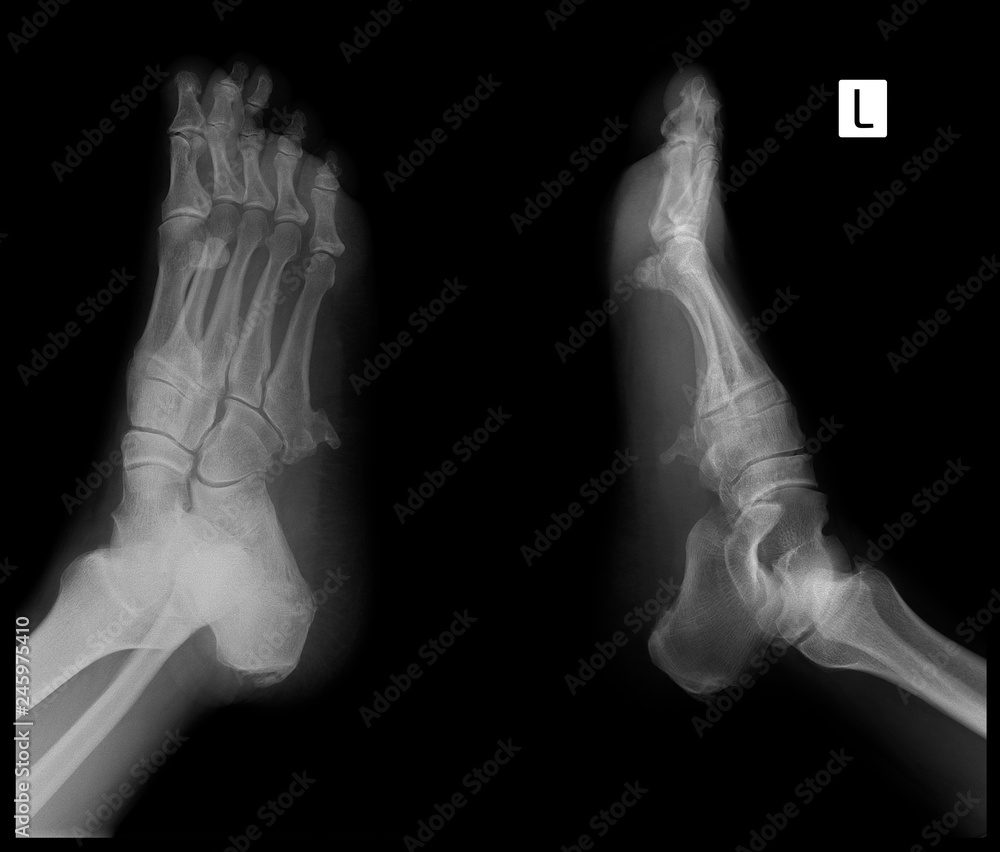 X Ray Of The Foot Exostosis Of The 5th Metatarsal Bone Stock Foto Adobe Stock