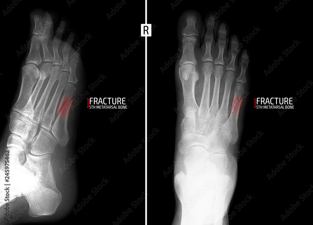 Foto de X-ray of the foot. Fracture of the 5th metatarsal bone. Marker ...