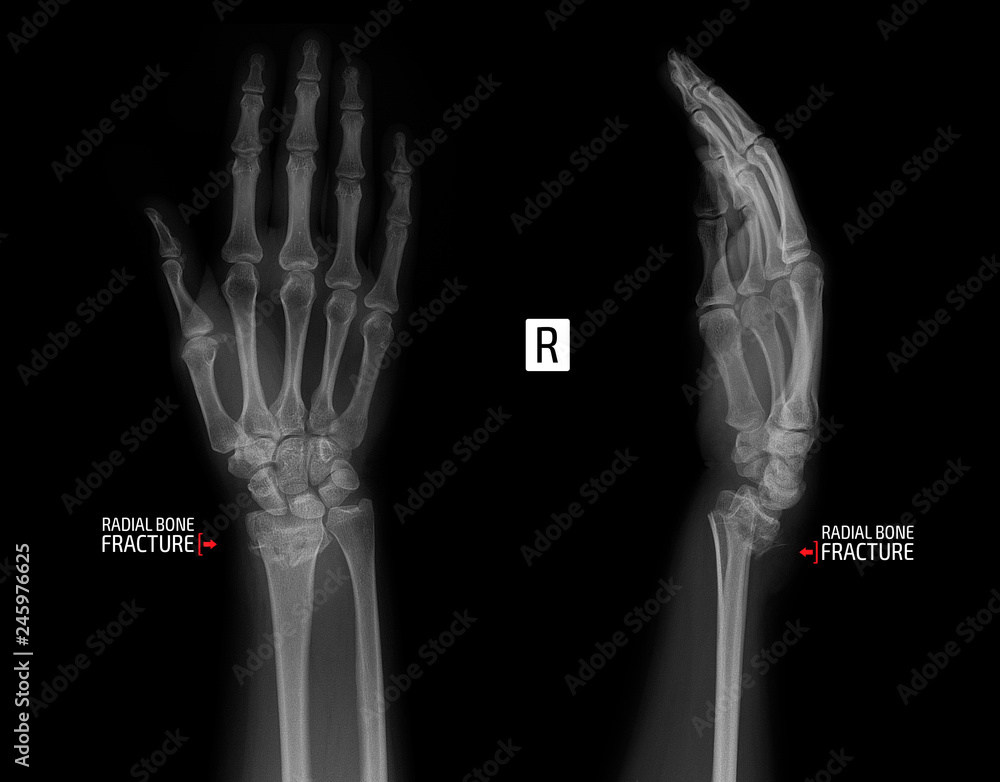 X-ray of the wrist joint. Fracture of the radius. Marker. Stock Photo ...