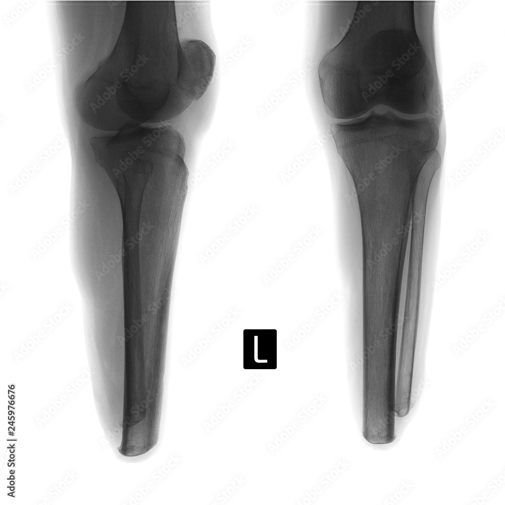 X-ray of the shin. Stump of the left shin. Negative. Stock Photo ...