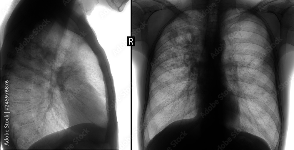 X-ray of the lungs: Tuberculosis of the lungs. Negative. Stock Photo ...